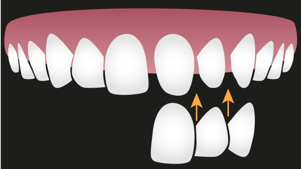 What are porcelain veneers? - Mint Dental of Anchorage